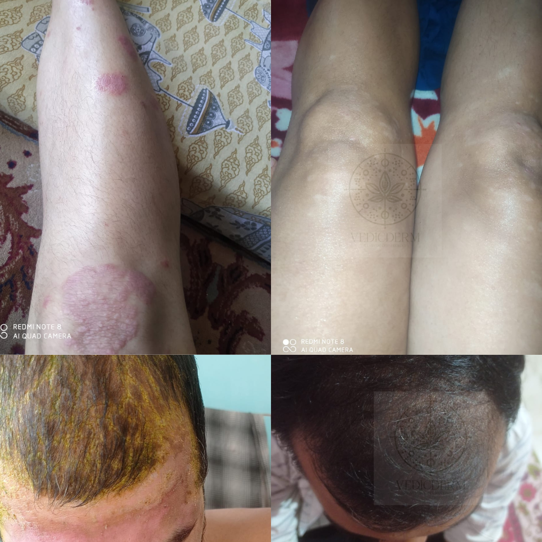 Vedicderm Ultimate Psoriasis Care Bundle – VEDICDERM