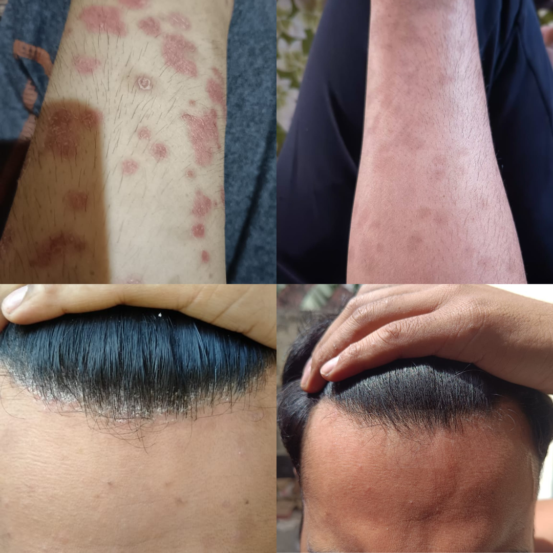 Vedicderm Ultimate Psoriasis Care Bundle – VEDICDERM