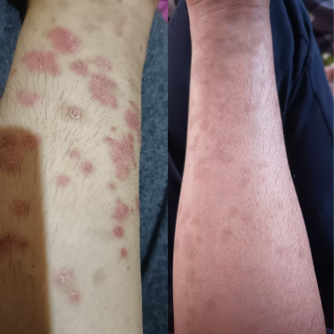 Oleander's Oil for Psoriasis, Eczema, Atopic Dermatitis – VEDICDERM