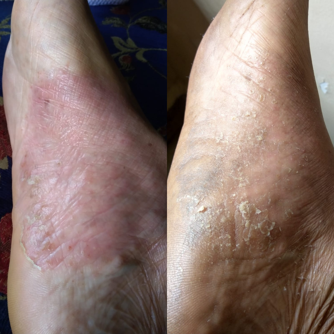 Vedicderm Ultimate Psoriasis Care Bundle – VEDICDERM